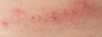 Voet eczeem | Oorzaak en tips | Sproet