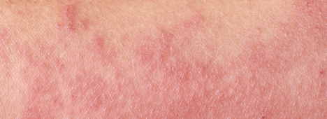 Voet eczeem | Oorzaak en tips | Sproet