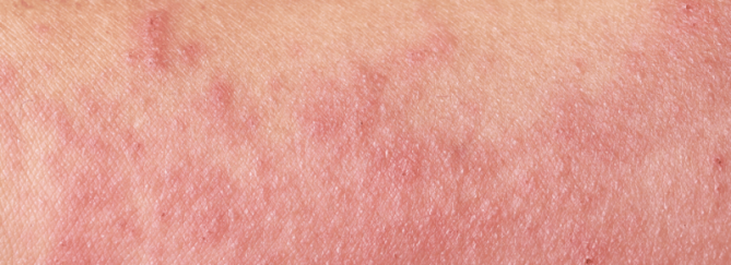 Voet eczeem | Oorzaak en tips | Sproet