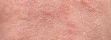 Voet eczeem | Oorzaak en tips | Sproet