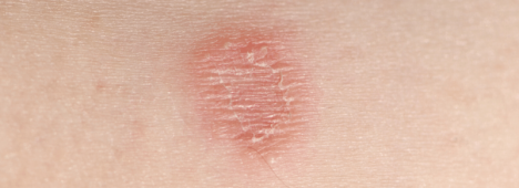 Voet eczeem | Oorzaak en tips | Sproet