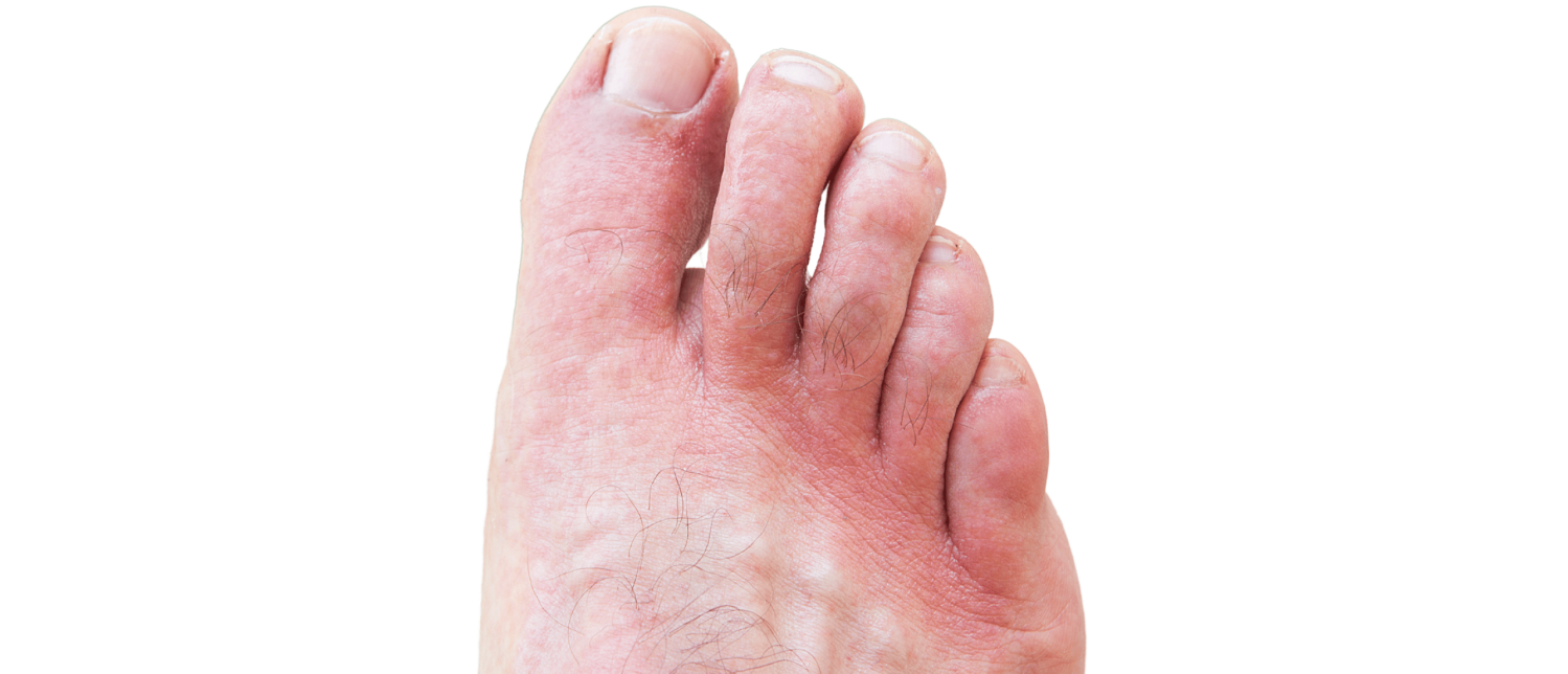Voet eczeem | Oorzaak en tips | Sproet