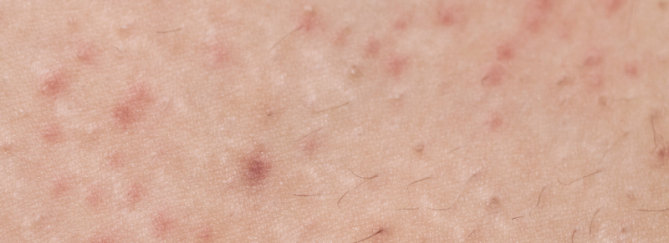 Ingegroeide haar bikinilijn | Oplossing