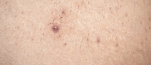 Ingegroeide haar bikinilijn | Oplossing