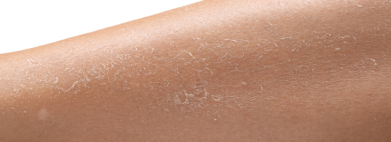 Een droge huid | Oorzaak en tips | Sproet