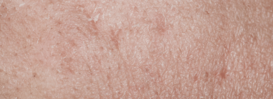 Een droge huid | Oorzaak en tips | Sproet