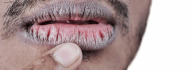 Droge lippen | Verminder droge lippen in 5 stappen | Sproet