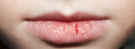 Droge lippen | Verminder droge lippen in 5 stappen | Sproet
