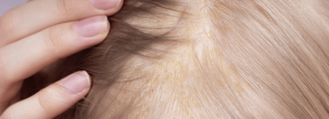 Hoofdhuid schilfers | Oorzaak en oplossing | Sproet