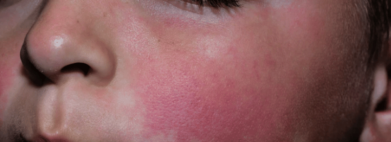 Vijfde ziekte | Oorzaak en tips | Sproet