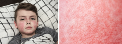 Roodvonk | Oorzaak en mijn tips | Sproet