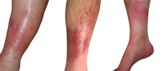 Roodvonk | Oorzaak en mijn tips | Sproet