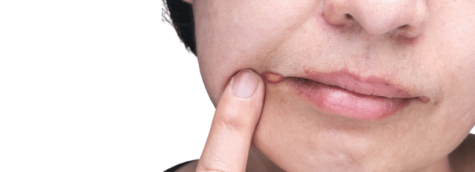 Gescheurde mondhoeken | Zo kom je er snel vanaf! | Advies huidtherapeut