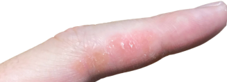 Handschimmel | Oplossing en behandeling | Sproet