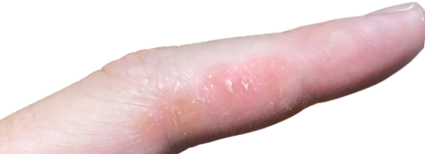 Handschimmel | Oplossing en behandeling | Sproet