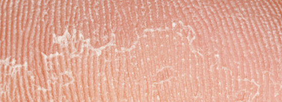 Hyperkeratose | Verdikte huid | Mijn tips!