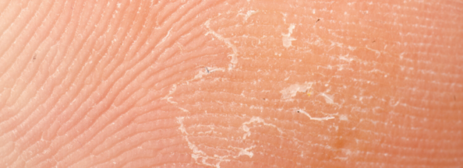 Hyperkeratose | Verdikte huid | Mijn tips!