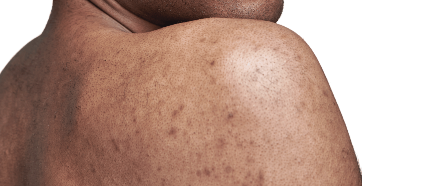 Huidproblemen met pigment | Oorzaak en tips | Sproet