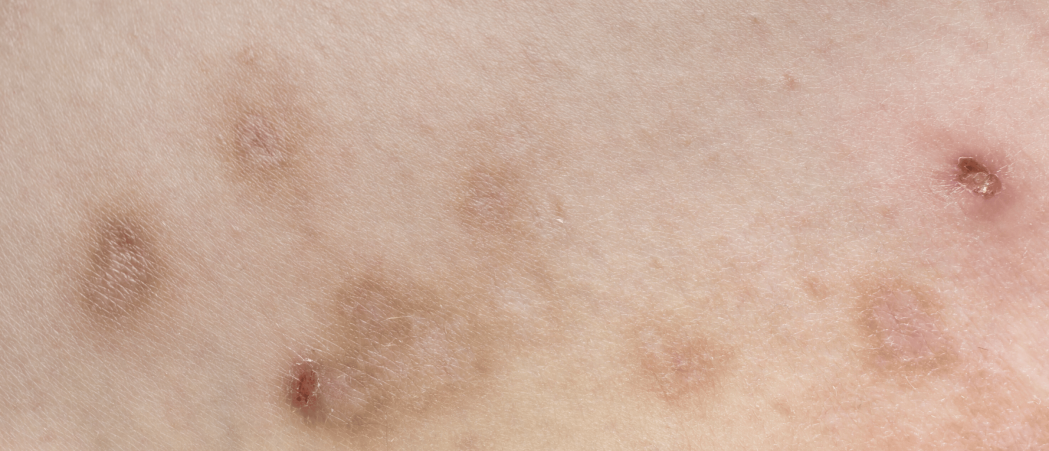 Prurigo Nodularis | Jeukende bulten | Mijn tips!