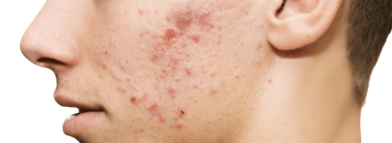 Acne conglobata | Wat kun je het beste doen?