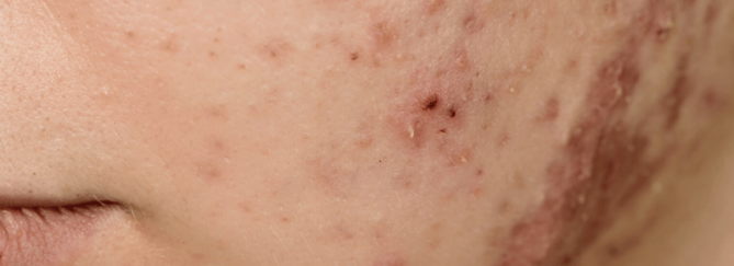 Acne conglobata | Wat kun je het beste doen?