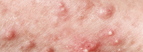 Acne conglobata | Wat kun je het beste doen?