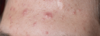 Acne conglobata | Wat kun je het beste doen?