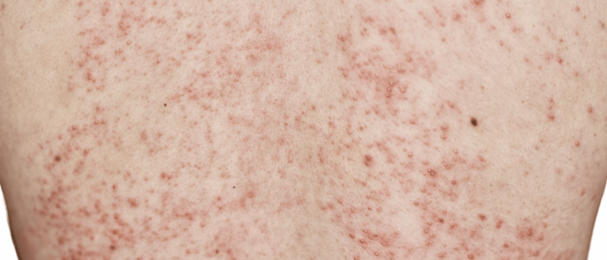 Ziekte van Grover | Jeukende bultjes | Mijn tips als huidtherapeut