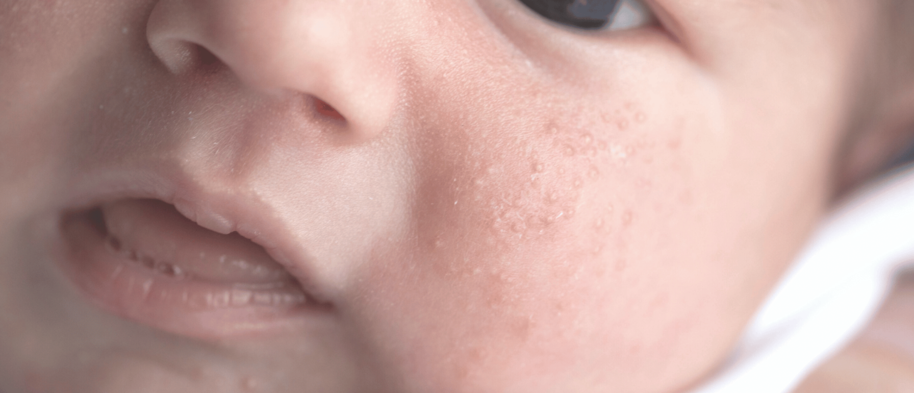Gerstekorrel baby | Wat te doen? | Sproet