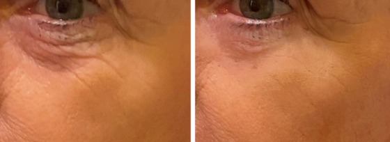 Remescar review | Werkt het echt? | Inclusief fotos!