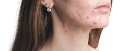 Huidproblemen na chemo | Sproet