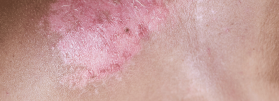 Huid na bestraling verzorgen | Mijn tips!