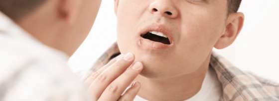 Beste koortslip zalf | Mijn top 5 als huidtherapeut