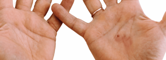 Eelt op hand | Oorzaak en tips | Sproet