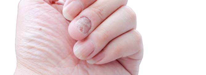 Handschimmel | Oplossing en behandeling | Sproet