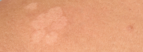 Handschimmel | Oplossing en behandeling | Sproet