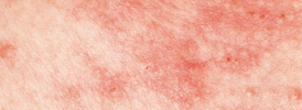 Schimmelinfecties huid | Oorzaak en behandeling | Sproet