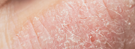 Soorten eczeem | Oorzaak en tips | Sproet