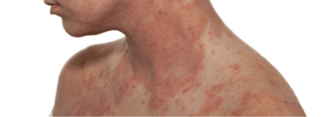 Soorten eczeem | Oorzaak en tips | Sproet