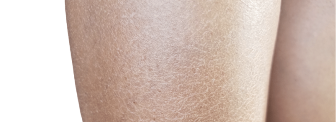 Jeukende benen | Oorzaak en tips van een huidtherapeut | Sproet