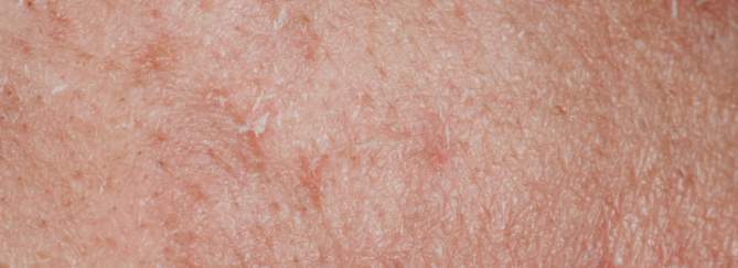 Rode huid gezicht | Oorzaak en tips | Sproet