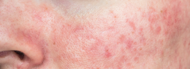 Rode huid gezicht | Oorzaak en tips | Sproet