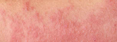 Rode huid gezicht | Oorzaak en tips | Sproet