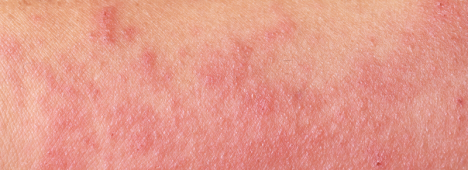 Rode huid gezicht | Oorzaak en tips | Sproet