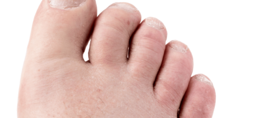 Wintertenen | Winterjeuk aan de tenen | Sproet