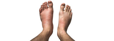 Wintervoeten | Winterjeuk voeten | Sproet