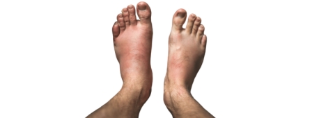 Wintervoeten | Winterjeuk voeten | Sproet