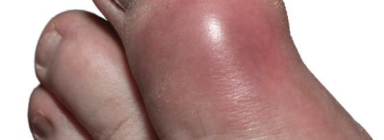 Wintertenen | Winterjeuk aan de tenen | Sproet