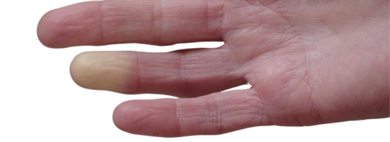 Wintervingers | Winterjeuk vingers | Sproet