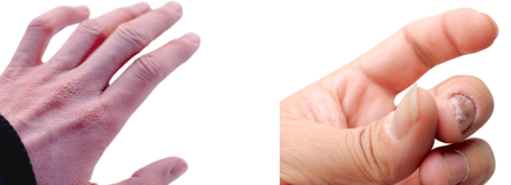 Wintervingers | Winterjeuk vingers | Sproet